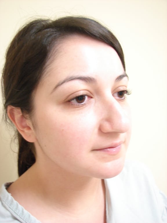 Case #7702 - Kimberly Henry M.D. Plastic Surgery